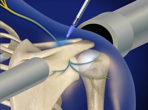 Genicular Nerve Block | New York Spine & Wellness Center